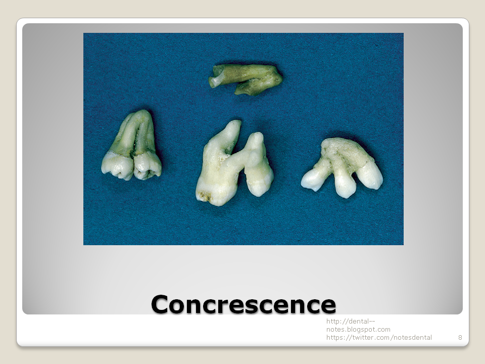 Dental Notes: Abnormalities of Teeth (Alterations in Shape) NOTES