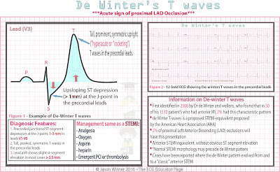 ECG Educator Blog : De Winters T waves