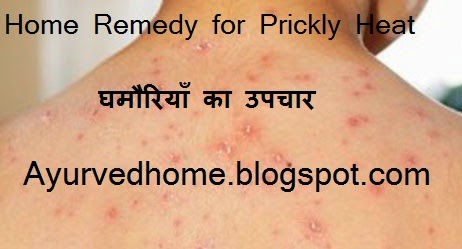 Ayurveda Home and Remedies with Nature: Prickly Heat Home Remedies ...