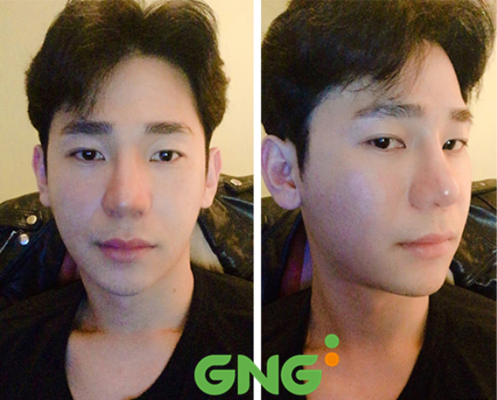 GNG Plastic Surgery Hospital: Jungwoo's Real Story at GNG Hospital