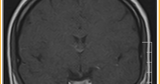 Pituitary Microadenoma: MRI - Sumer's Radiology Blog