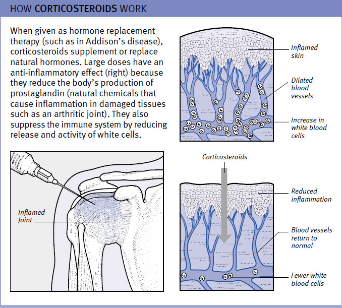 corticosteroid drugs ~ Nursing