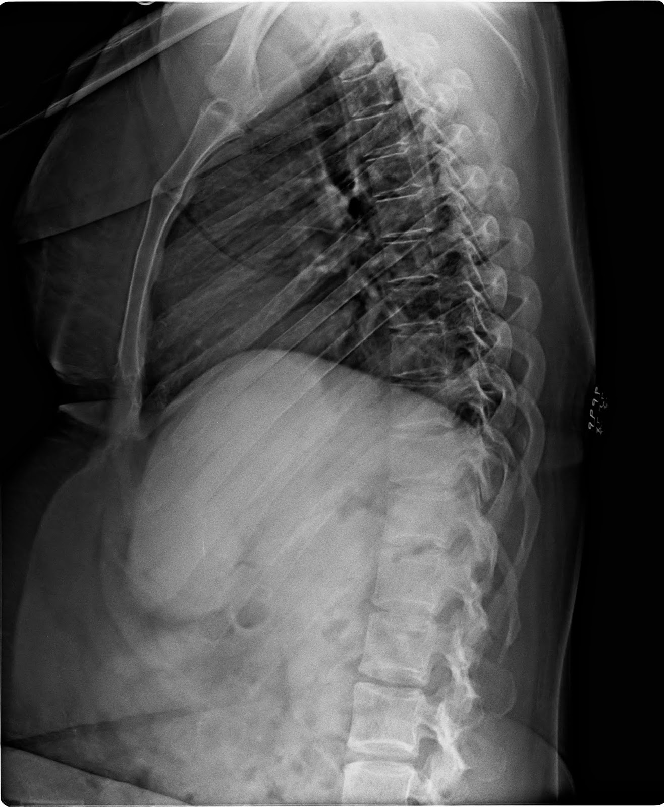 ASTHACARE- SPANDAN IMAGING CENTRE : SONALBEN PATEL F/39Y D.L SPINE-AP/LAT