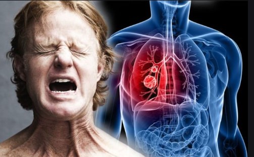 Lung cancer - symptoms and early signs in men - CancerOz