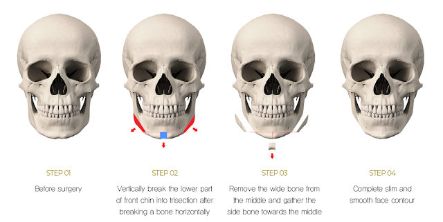 How to achieve an amazing V-line face - Korean Cosmetic Surgery Clinic ...