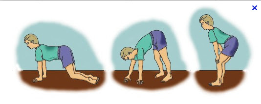 Quike & Vivi's World: Gowers' maneuver Duchenne Muscular Dystrophy