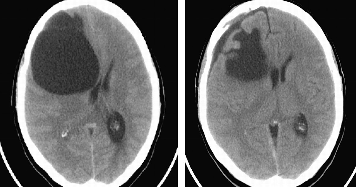 Arachnid cyst:spider webs in the brain (Part I)