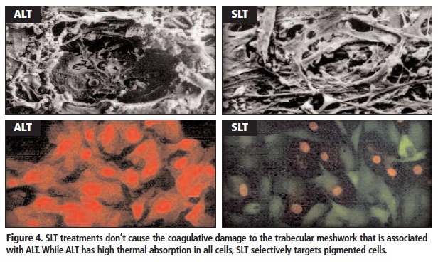 Glaucoma Specialist Blog: The "Glog": May 2018