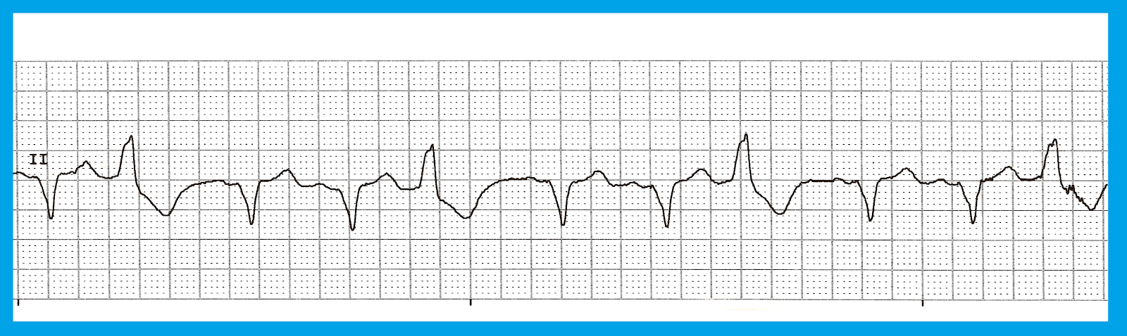Basic EKG Rhythm Test 22