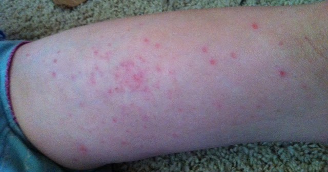 Let's Not Be Rash: Staph Staph Go Away