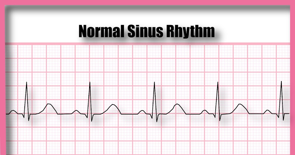 ECG Educator Blog : Normal Sinus Rhythm