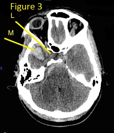 Rappels : Imagerie des lésions traumatiques crâniennes - Cas Imagerie