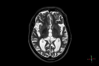 NPH and CSF flow studies - Radiology Imaging