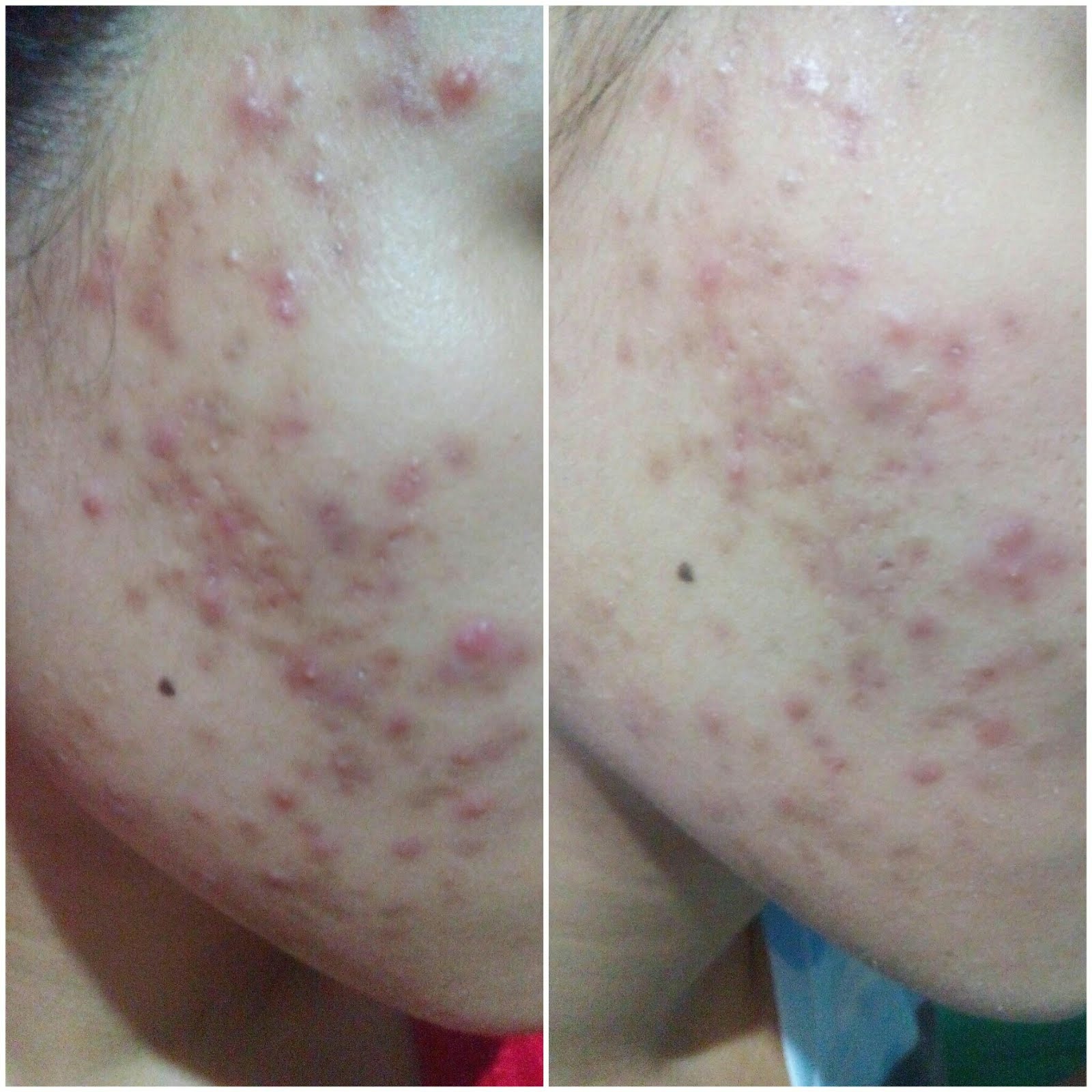 Maxi-peel + Eskinol review: Maxi Peel + Eskinol Review