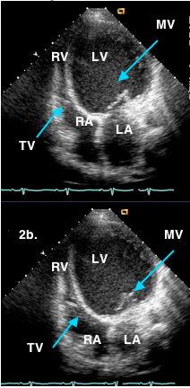 Echocardiogram Heart Failure