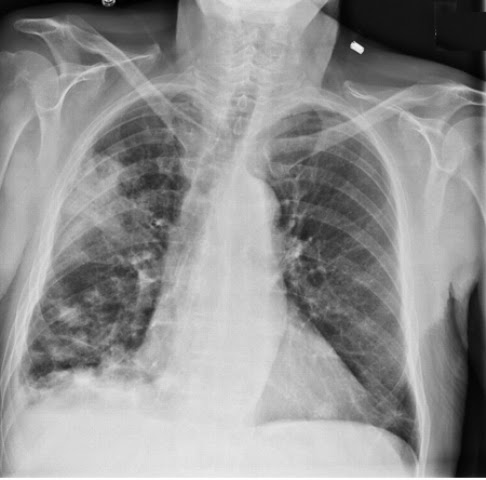 Medical Addicts: Chest X-ray: Nocardial pneumonia