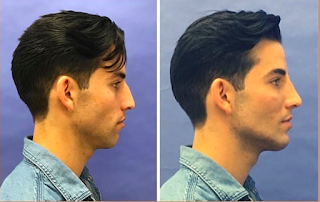 THE IMPORTANCE OF A STRONG JAWLINE - HOW TO ACHIEVE ONE