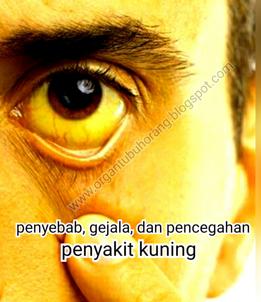kesehatan: JENIS, PENYEBAB DAN CARA MENCEGAH PENYAKIT KUNING
