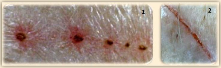 Malassezia Yeast ~ My Story * ~: Malassezia Yeast Lesion Stages - Types ...