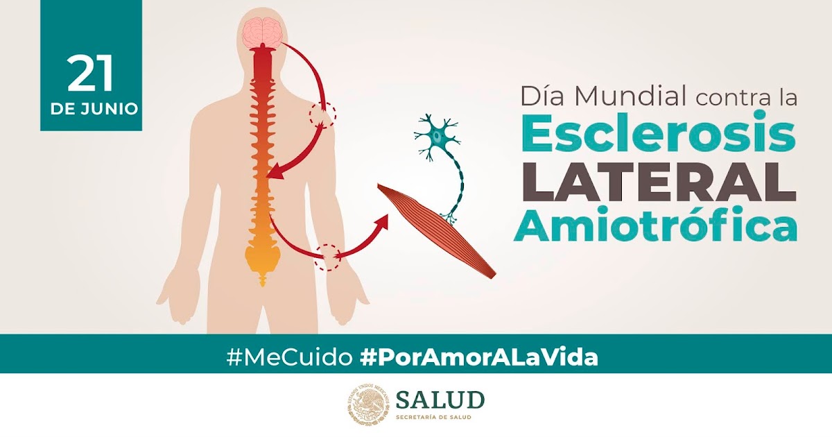 ESCLEROSIS LATERAL AMIOTRÓFICA EMPIEZA CON CALAMBRES Y ENTUMECIMIENTO