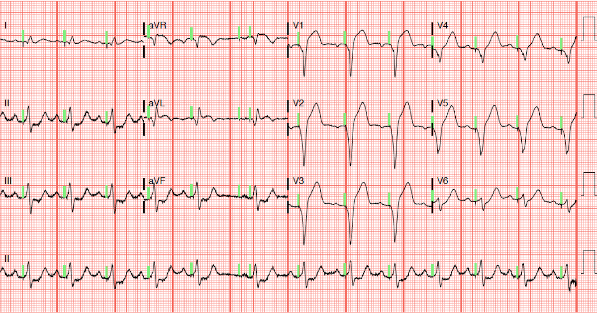 Dr. Smith's ECG Blog: A patient with a ventricular paced rhythm and ...