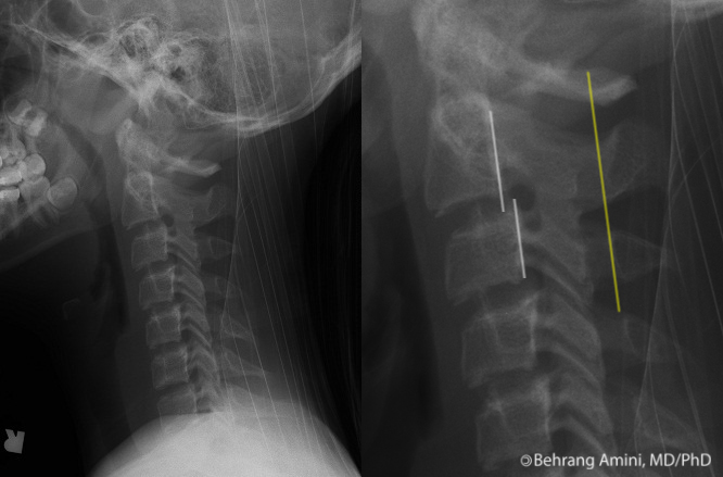 Roentgen Ray Reader: Pseudosubluxation