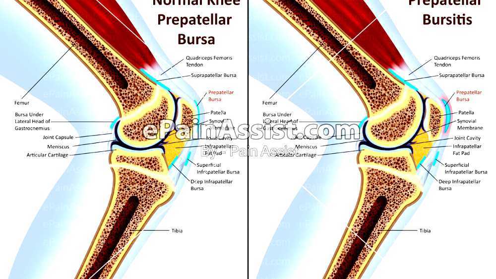 Prepatellar bursitis