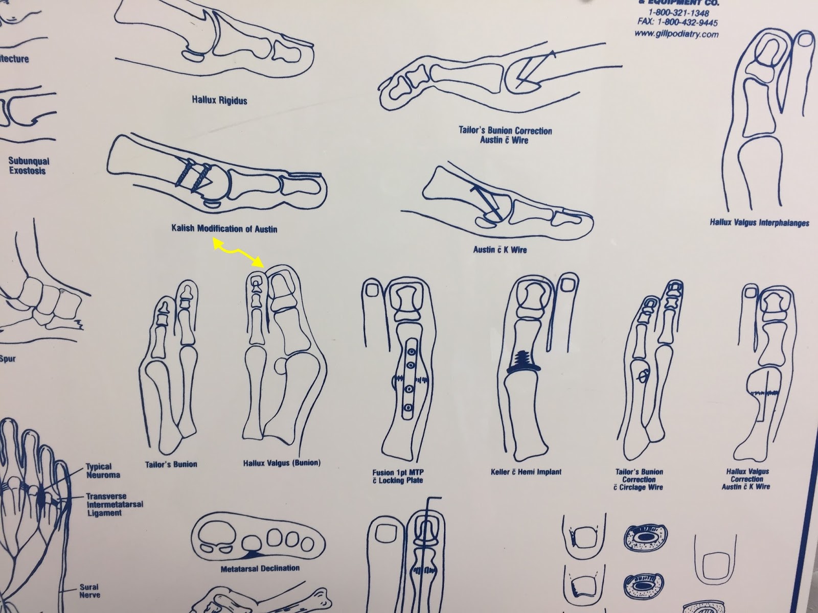 Before, During, & After Bunion Surgery...: February 2018