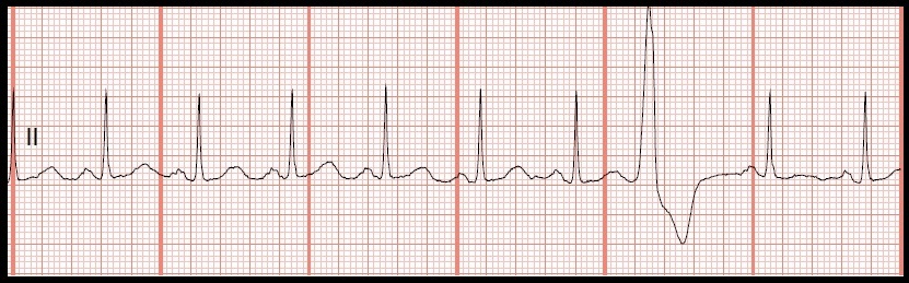 EKG Rhythm Strip Quiz 138