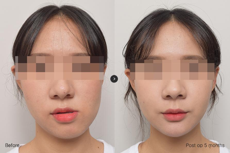 Asymmetrical Face Surgery Before And After