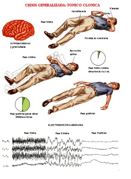 mioclonias: Mioclonias
