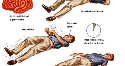 mioclonias: Mioclonias