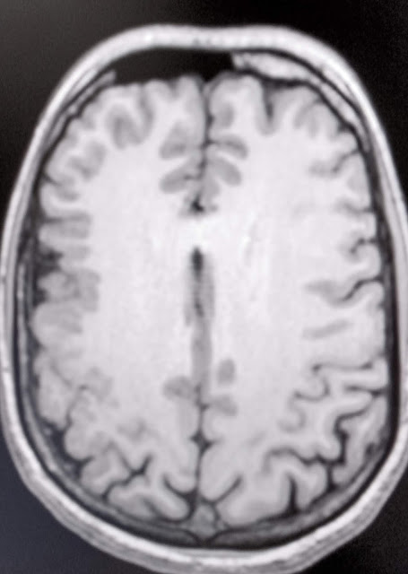 Polymicrogyria : MRI Teaching Case - Sumer's Radiology Blog