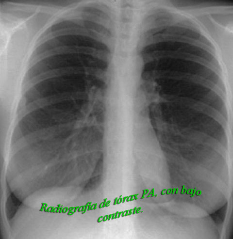 Radiología y Física Médica U.de Chile 2013: Contraste radiográfico