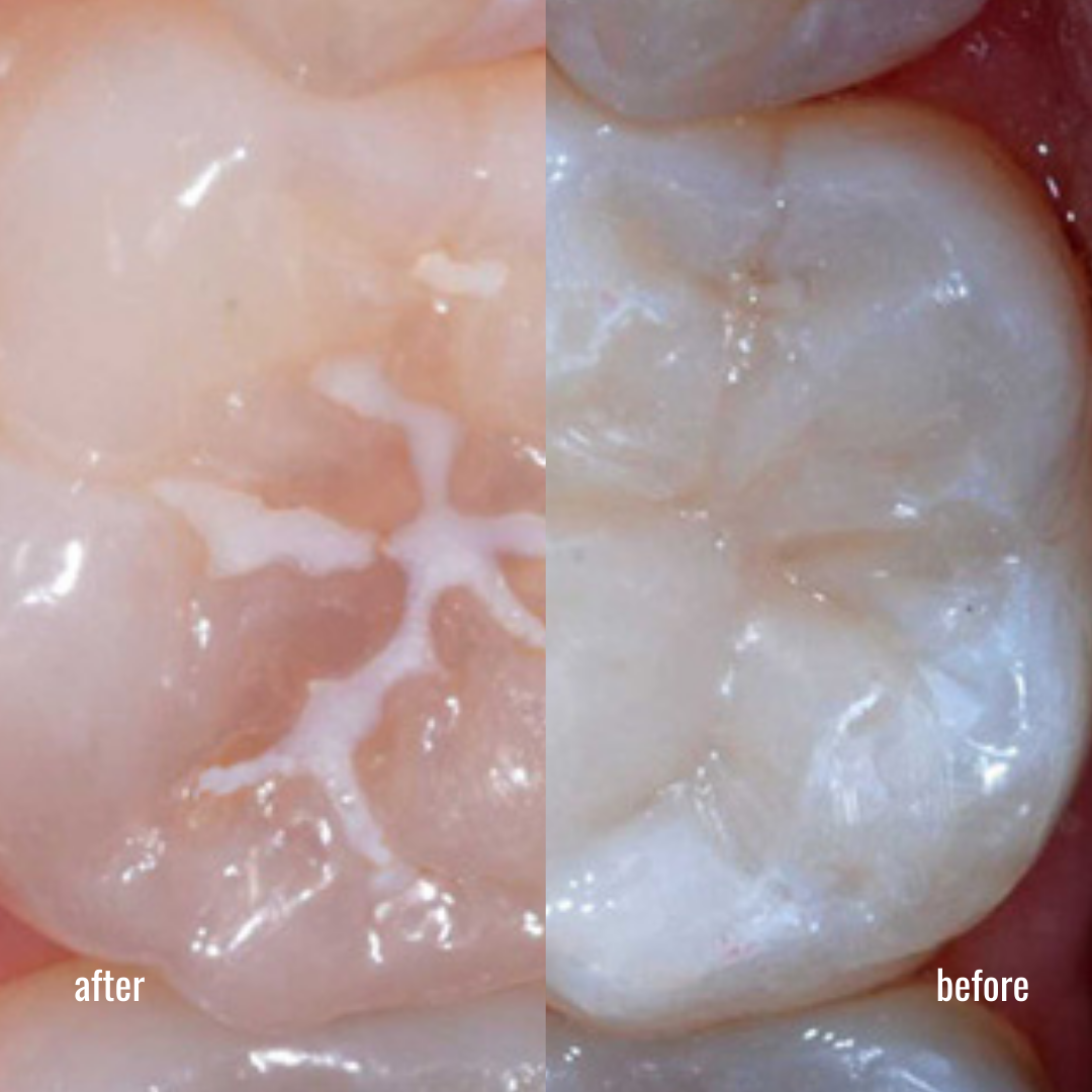 Your smile matters to us!: Korona Dental Explains why Fissure Sealing ...