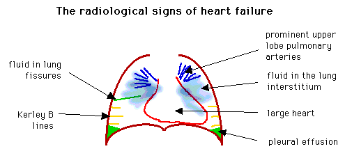 Medical Emergencies by Chathurika: Acute Left Ventricular Failure