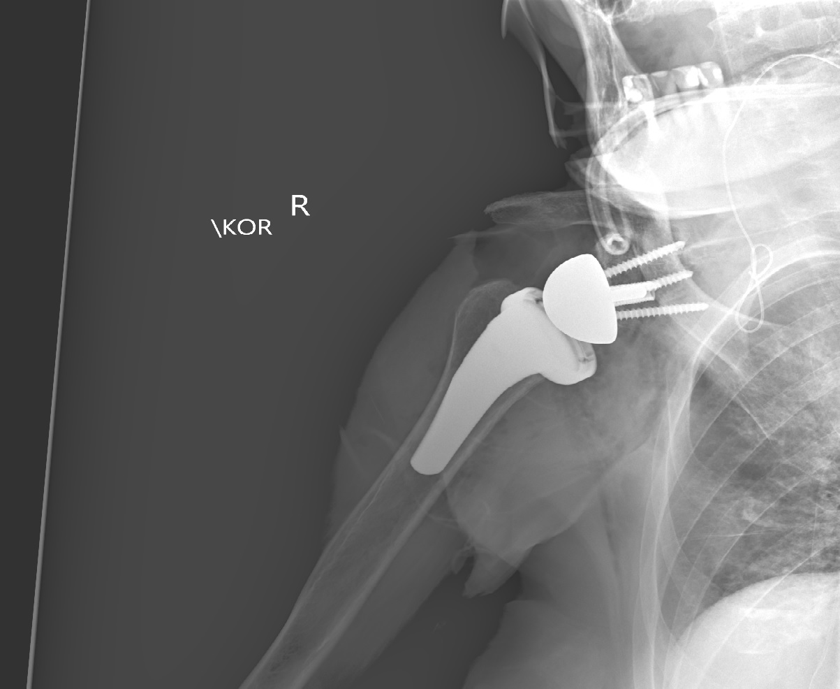 Shoulder and Elbow Surgery: Short stems in reverse total shoulder ...