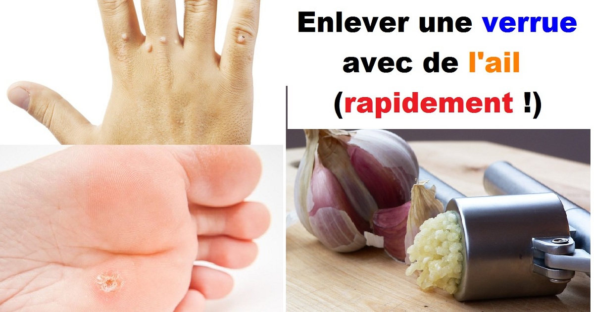 Enlever une verrue avec de l'ail: Le remède ancestral ~ Sport et Santé