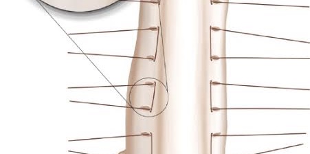 Técnica de plicatura por puntos para la Enfermedad de La Peyronie