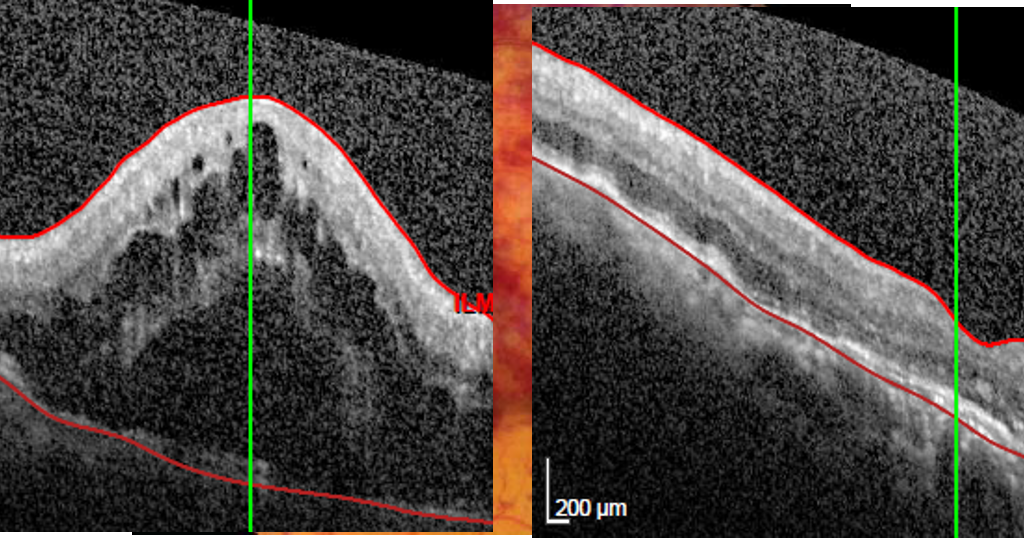 Retina e Catarata - Fortaleza: OCT Macula