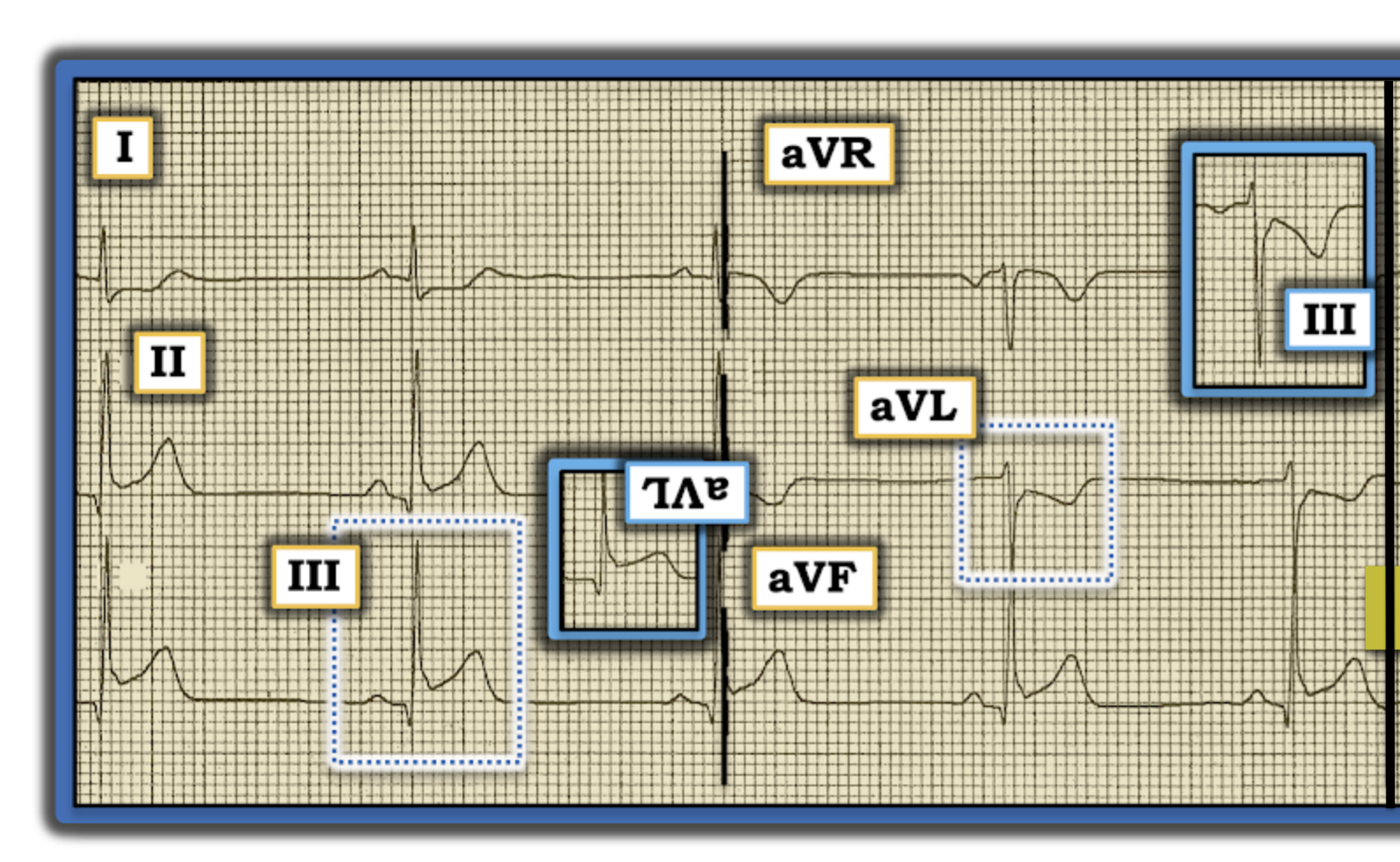 ECG Interpretation: ECG Blog #184 (ECG MP-2) — Magical Lead 3- Lead aVL ...