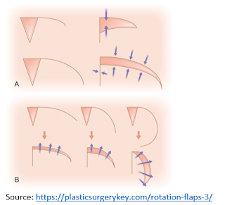 OHIMA Blog: Coding for Adjacent Tissue Transfers