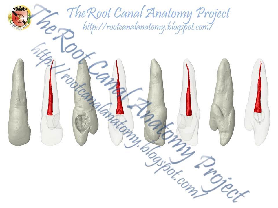 The Root Canal Anatomy Project: Peg-Shaped Lateral Incisors (Conoid)