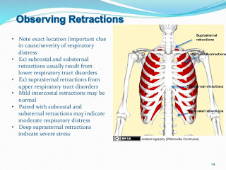 intercostal retractions - USA News Collections