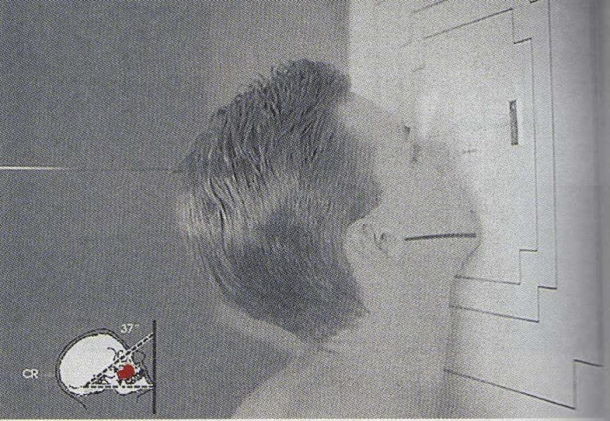 Catatan Ku: Teknik Radiografi Sinus Paranasal