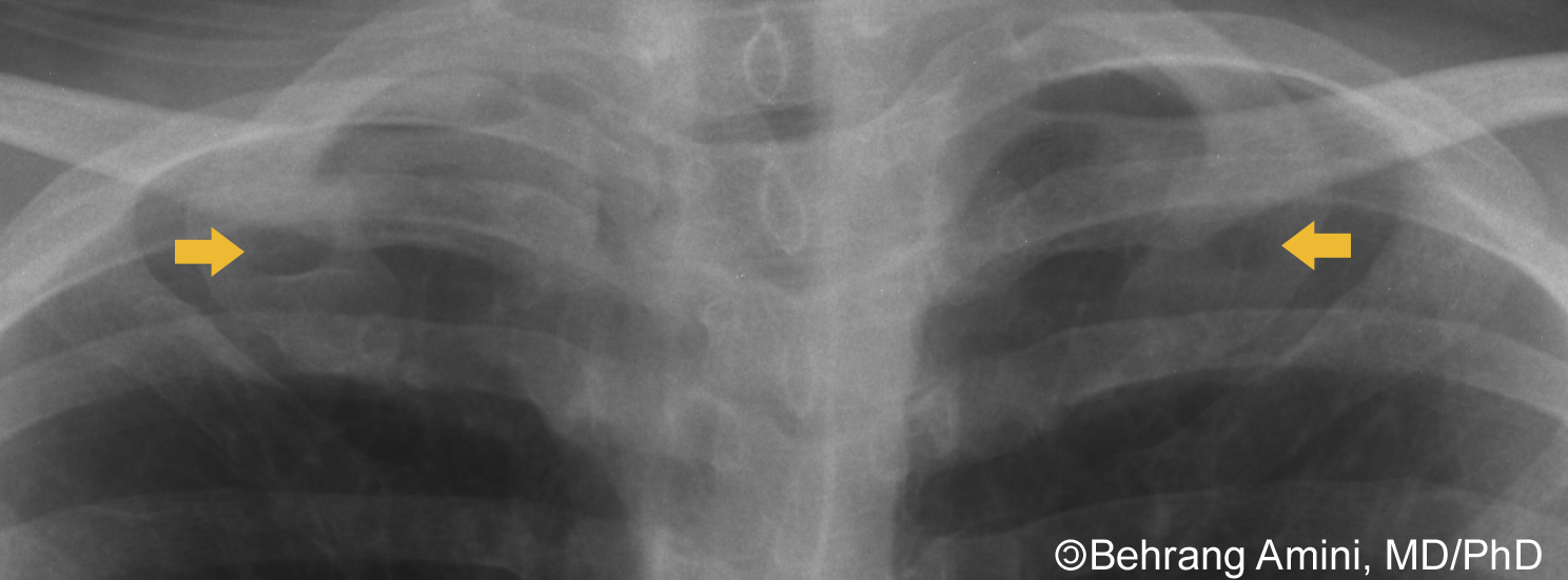 Roentgen Ray Reader: Anterior Rib Lucencies