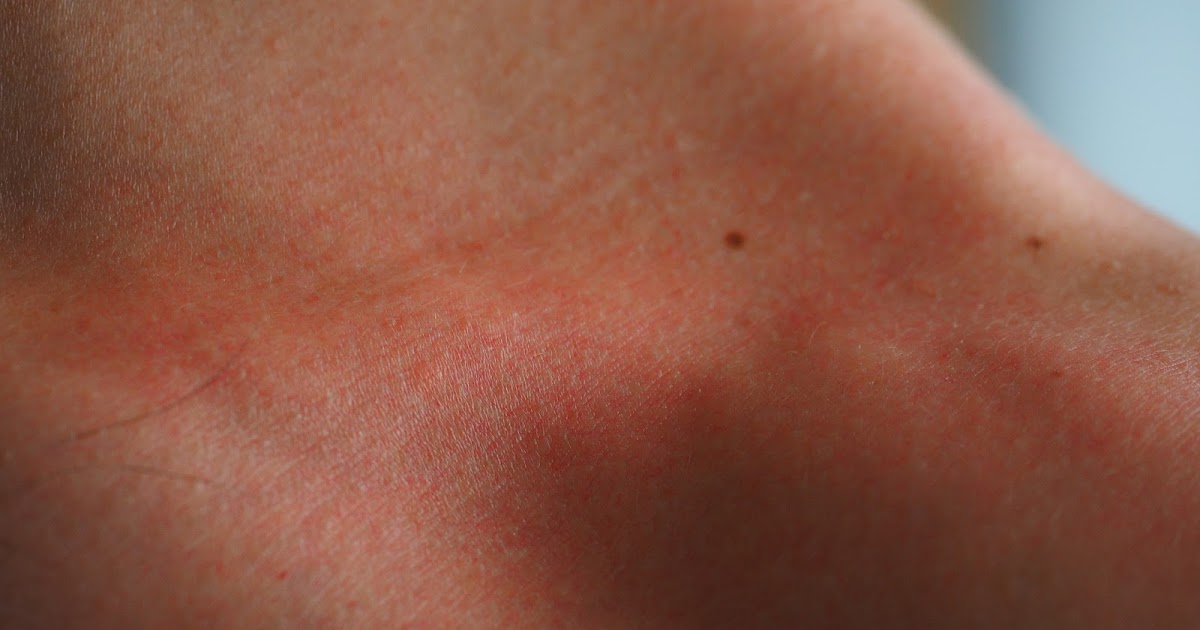 LA XÉROSE OU LA SÉCHERESSE DE LA PEAU - Africa Green Magazine