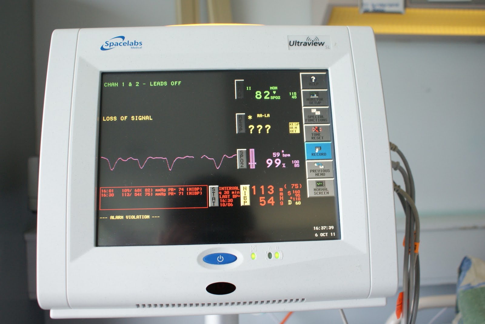 Braces + SARPE/SARME Surgery