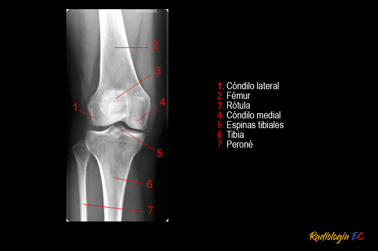 Radiografia de Rodilla