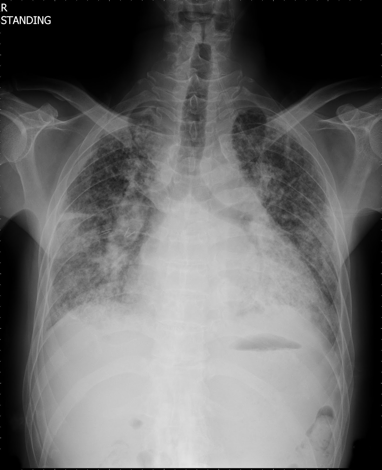 CXR 胸部x光判讀 IPF